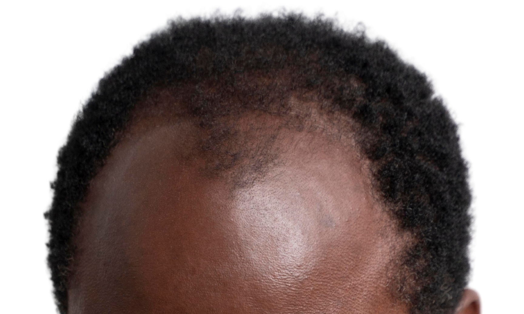 Rapid Reinvent: Hair Regrowth Treatment Solutions